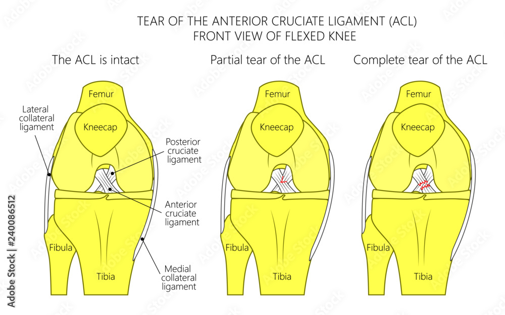 Vector illustration of a healthy knee joint with intact, partial tear ...