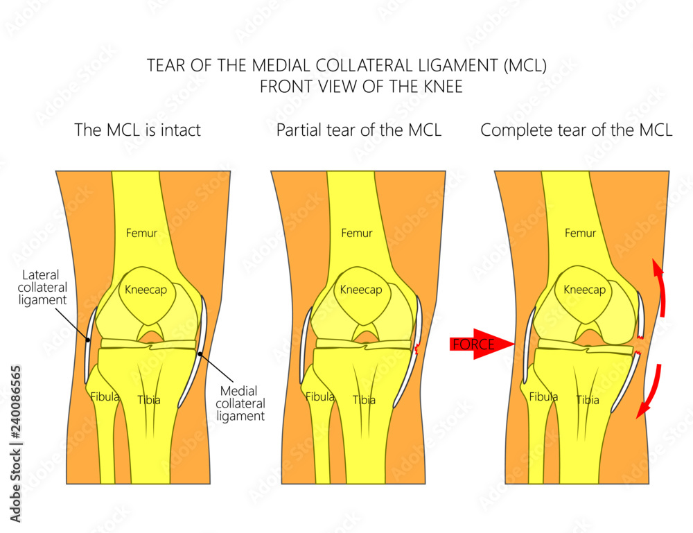 Vector illustration anatomy of a knee joint with healthy ligaments and ...
