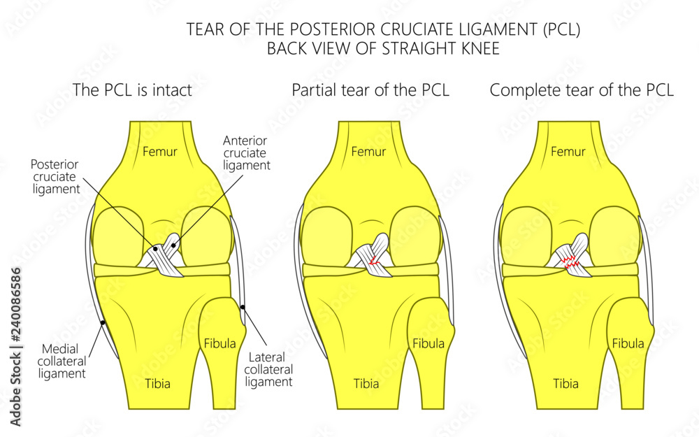 Poster Vector illustration of healthy knee joint with intact ligaments ...