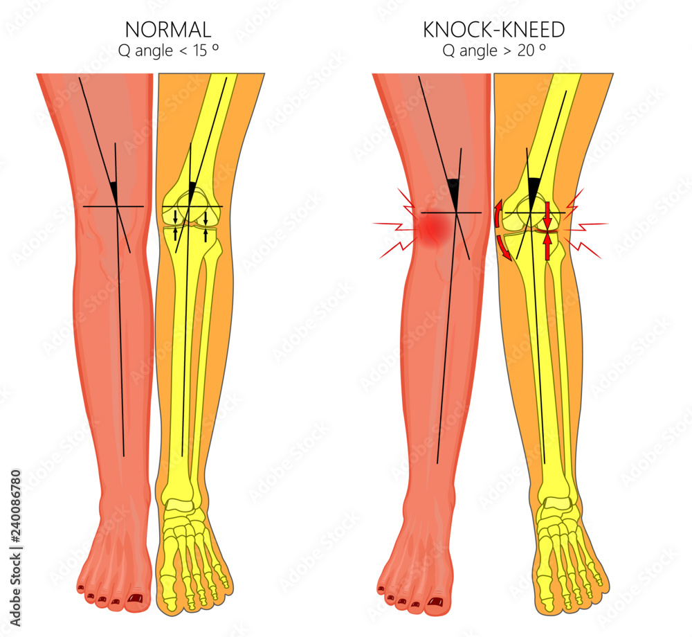 Vector illustration diagram. Shapes of human legs. Normal and curved ...