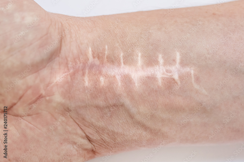 Scar with stitches on the wrist after surgery. Fracture of the bones of ...