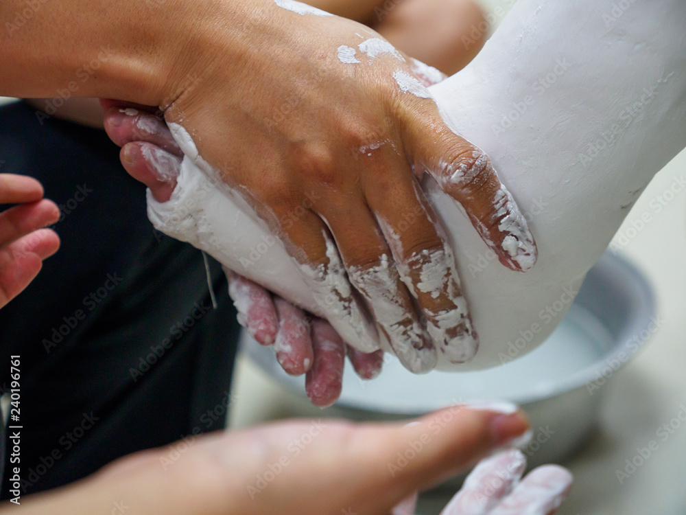 Closeup detail of a physician molding a newly-formed gypsum plaster leg ...