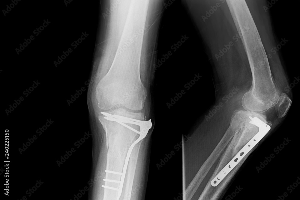 Show image of x-ray both leg and show external fixation of them. Stock ...