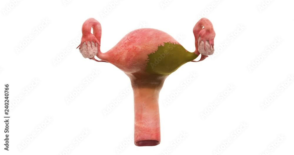 Disease spread on uterus, 3d animation. 3D rendering isolated on white ...