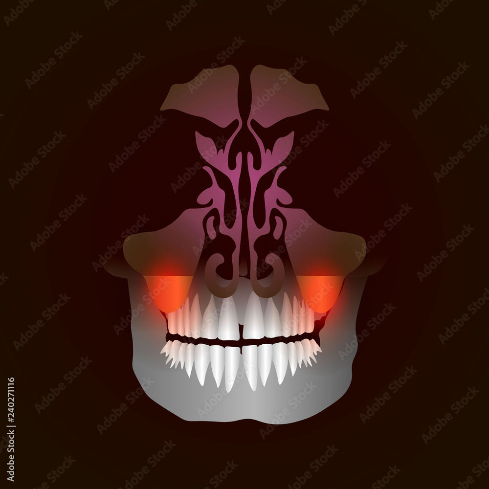 Odontogenic sinusitis. Inflammation of the maxillary sinuses due to a ...