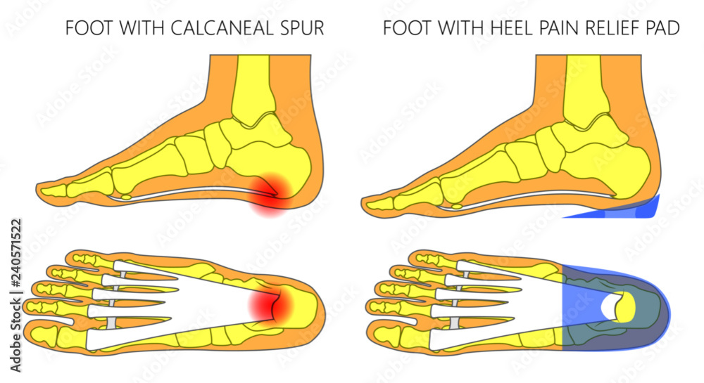 Vector illustration. Human foot with calcaneal spur, plantar fasciitis ...