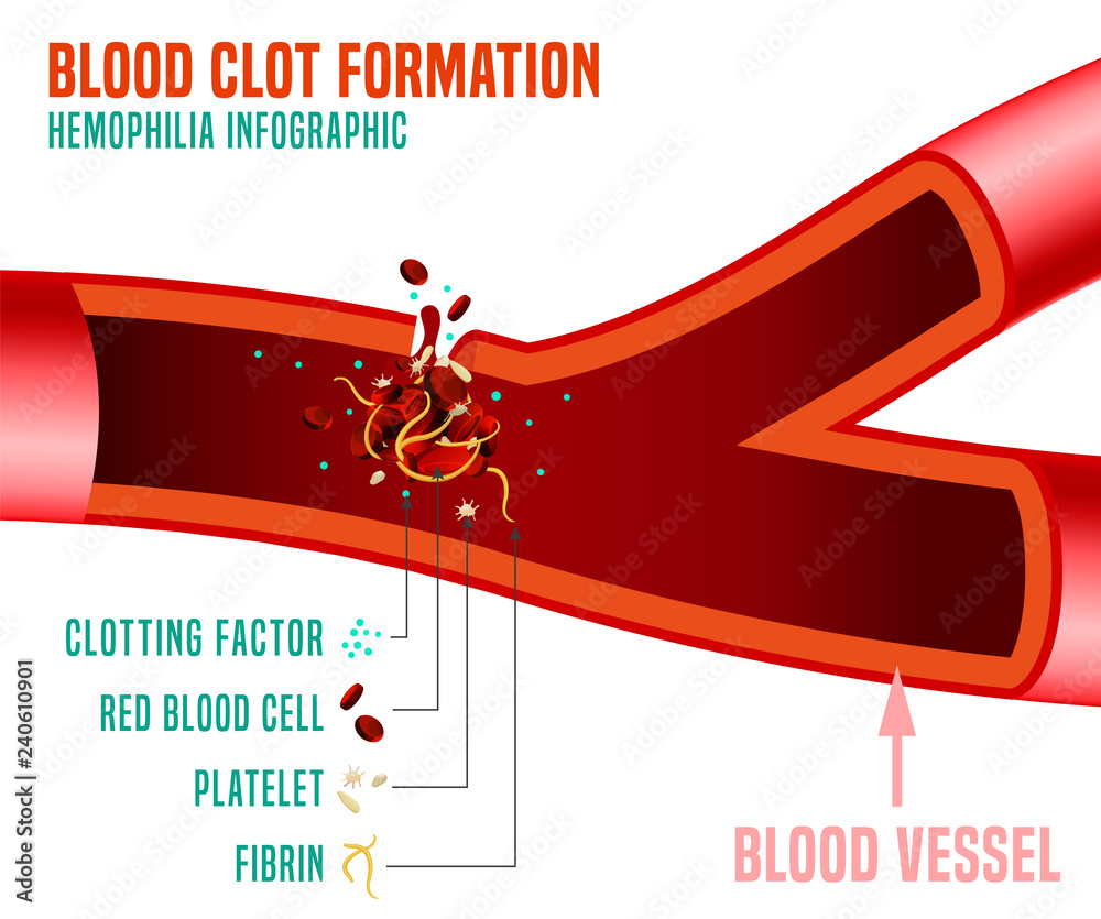 Blood clot formation Stock Vector | Adobe Stock