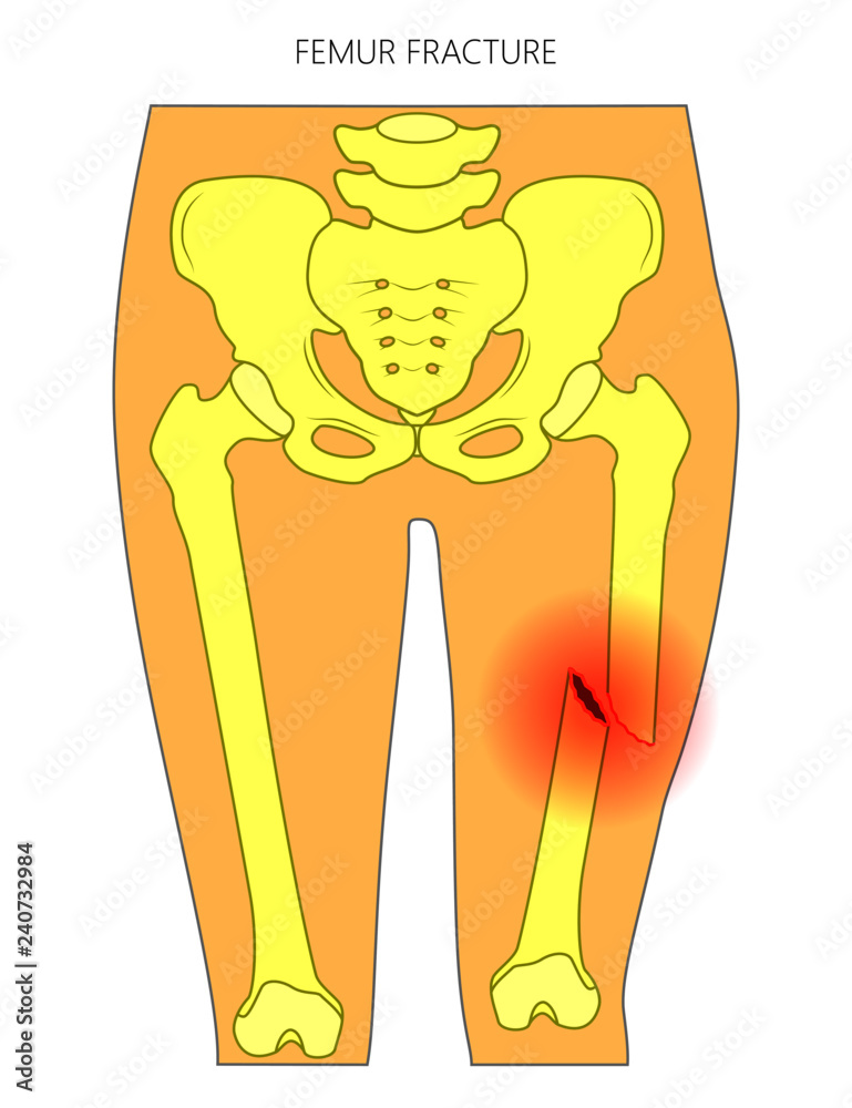 Human Femur Broken