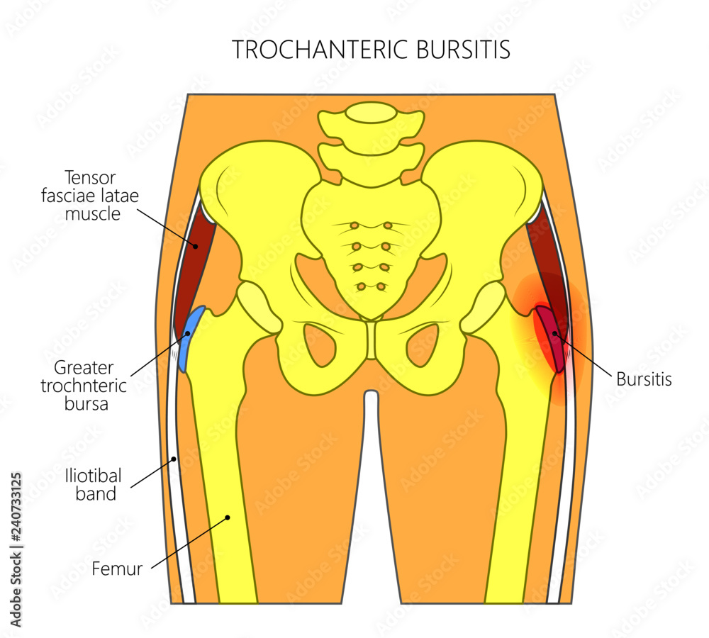 Póster Vector illustration of a human pelvis and hip with pain in the ...