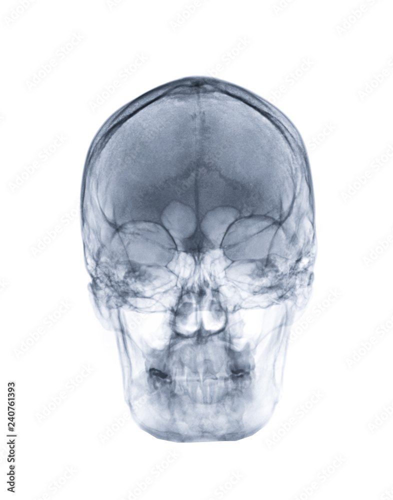 Skull X Ray Front