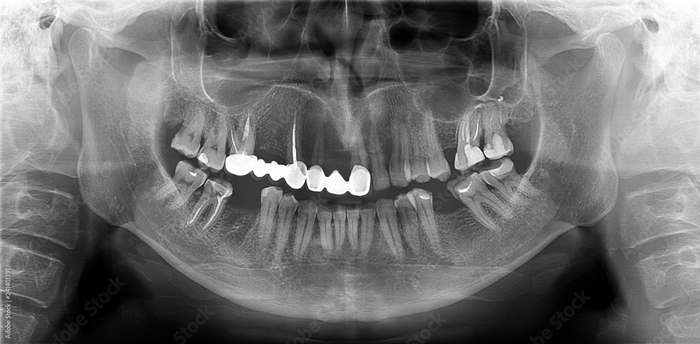 A panoramic radiograph is a panoramic scanning dental X-ray of the ...