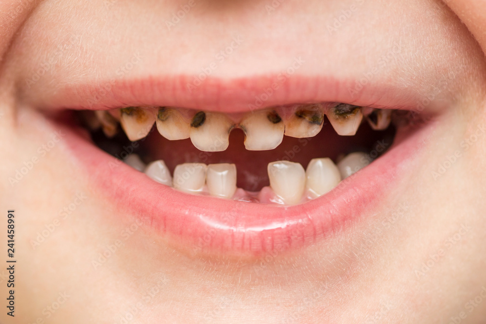 Kid patient open mouth showing cavities teeth decay. Close up of ...