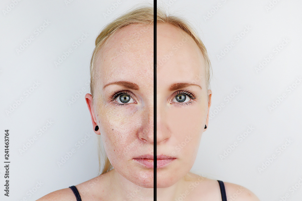 Oily skin and clear skin. Two photos before and after. Portrait of a ...