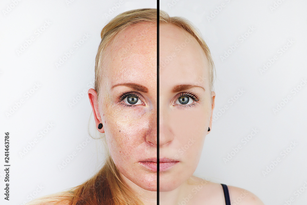 Oily skin and clear skin. Two photos before and after. Portrait of a ...