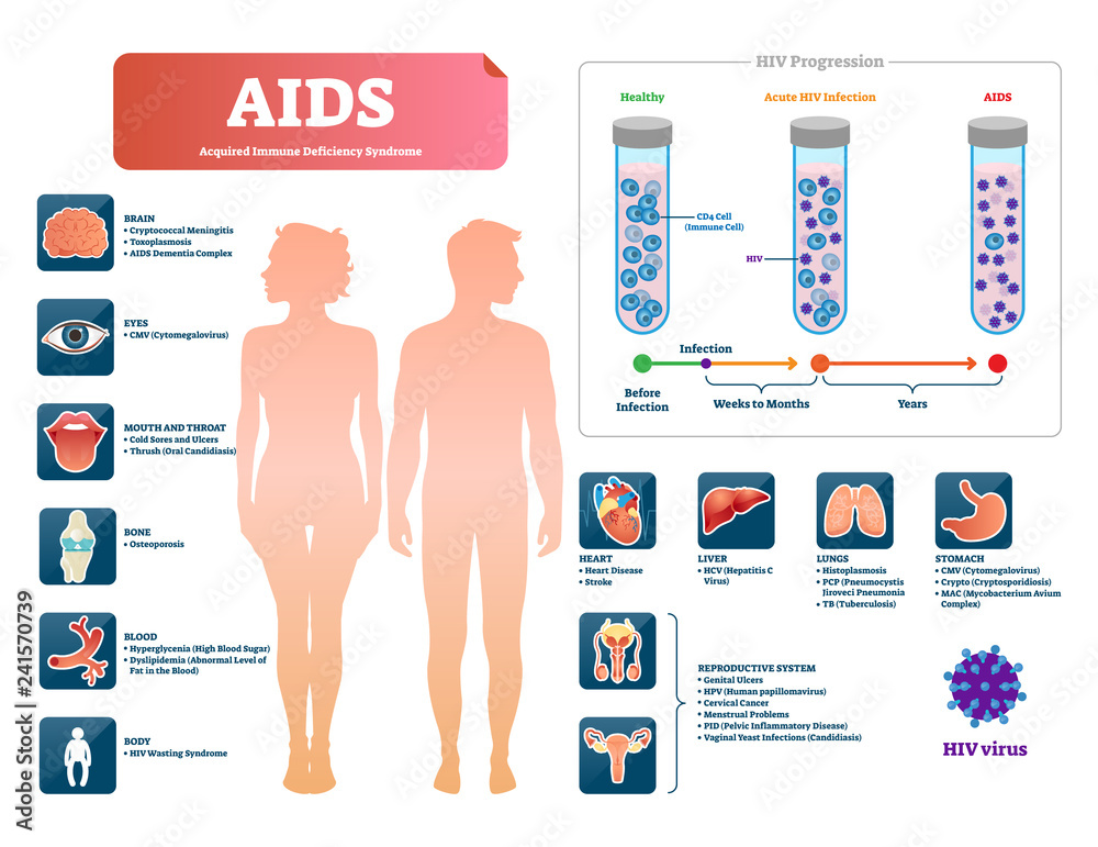 Aids Diagram