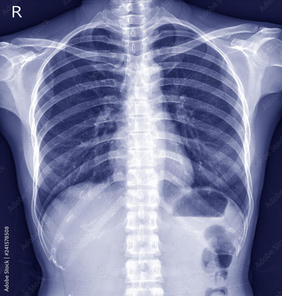 Chest x-ray normal. Stock Photo | Adobe Stock