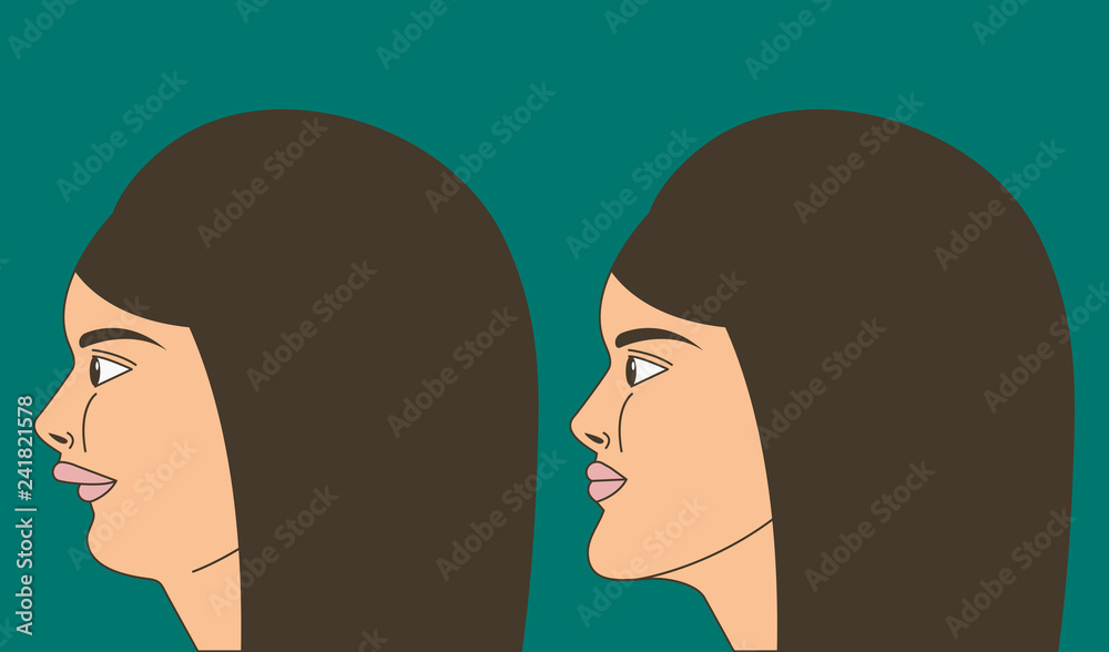 Distal bite, woman with malocclusion Stock Vector | Adobe Stock