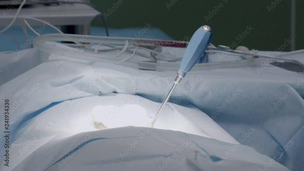 patient under general anesthesia is covered by sterile fabrics ...