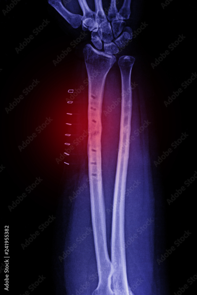 Arm Bone Fracture Surgery at Andrew Rhone blog
