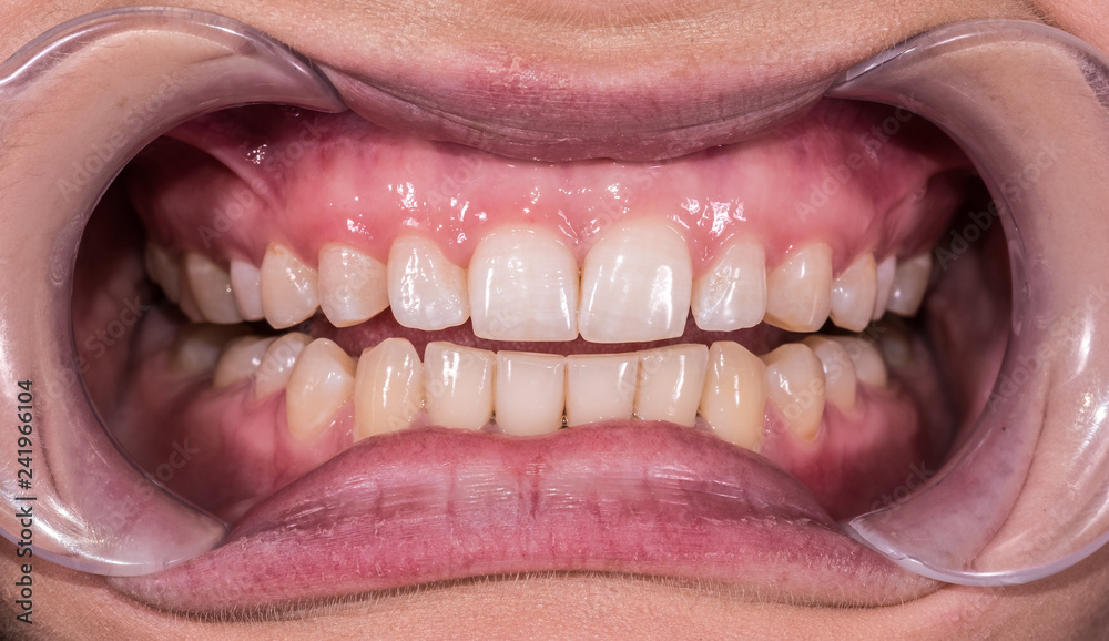 Healthy human teeth with normal occlusion from frontal intraoral view ...