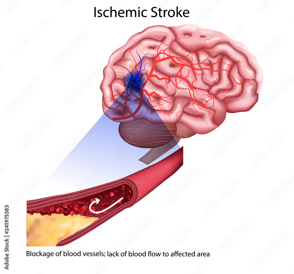 Stroke types poster, banner. Vector medical illustration. white ...