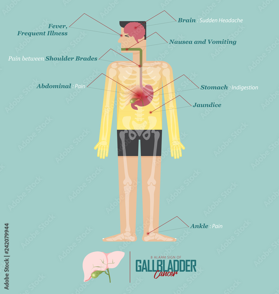 Alarm signs of Gallbladder cancer infographic in flat design ...