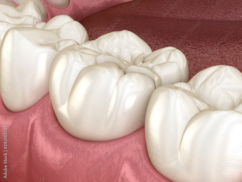 Inlay ceramic crown fixation over tooth. Medically accurate 3D ...
