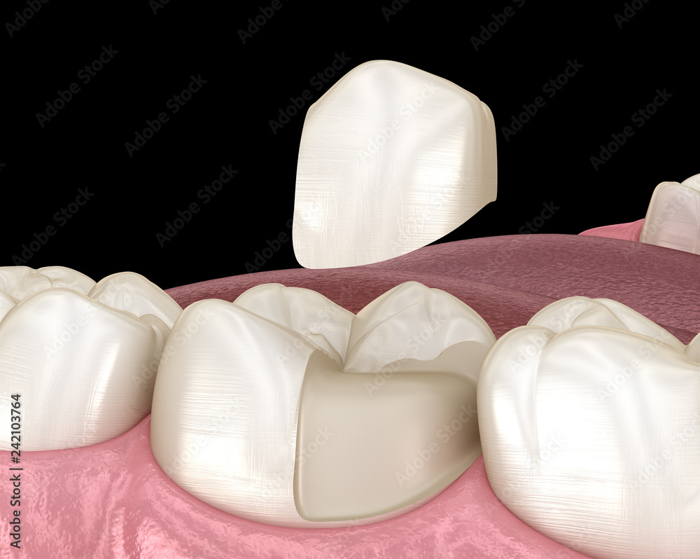 Onlay ceramic crown fixation over tooth. Medically accurate 3D ...