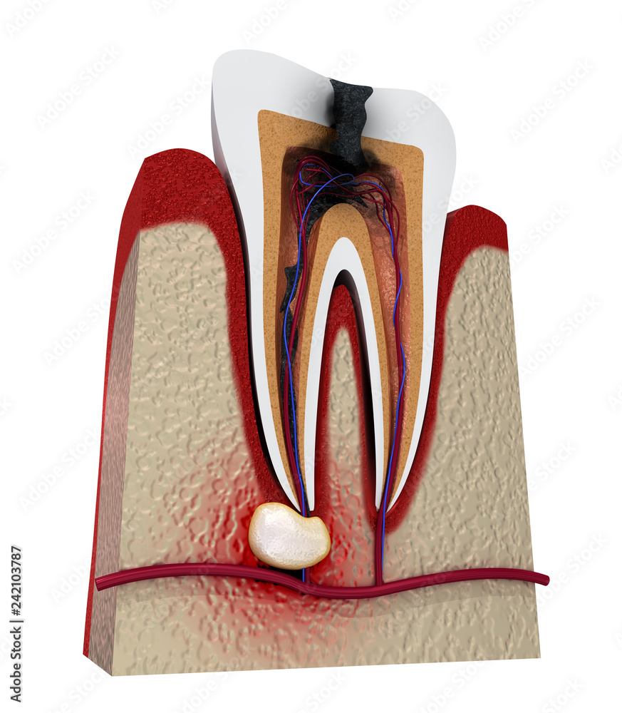 Tooth decay. Medically accurate tooth 3D illustration Stock ...