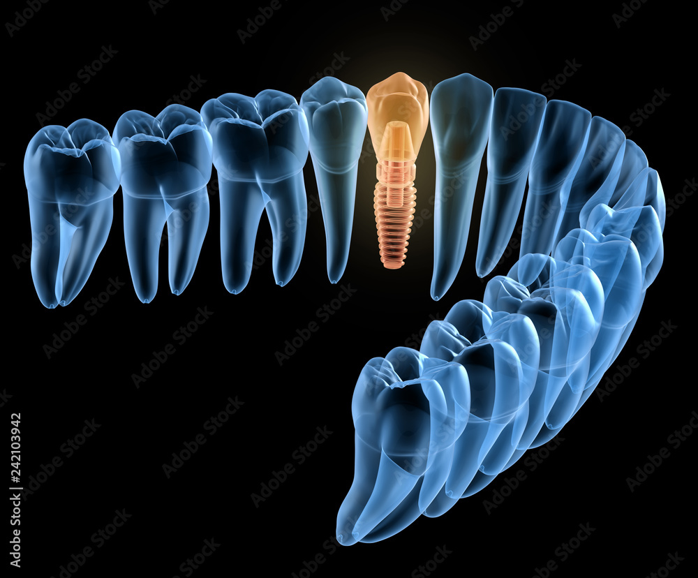 Premolar tooth recovery with implant, x-ray view. Medically accurate 3D ...