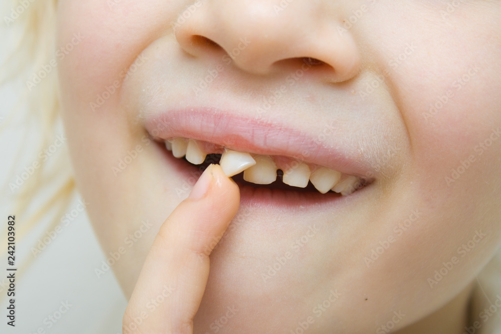 The baby girl smiling and shaking wobbly milk tooth in open mouth with ...