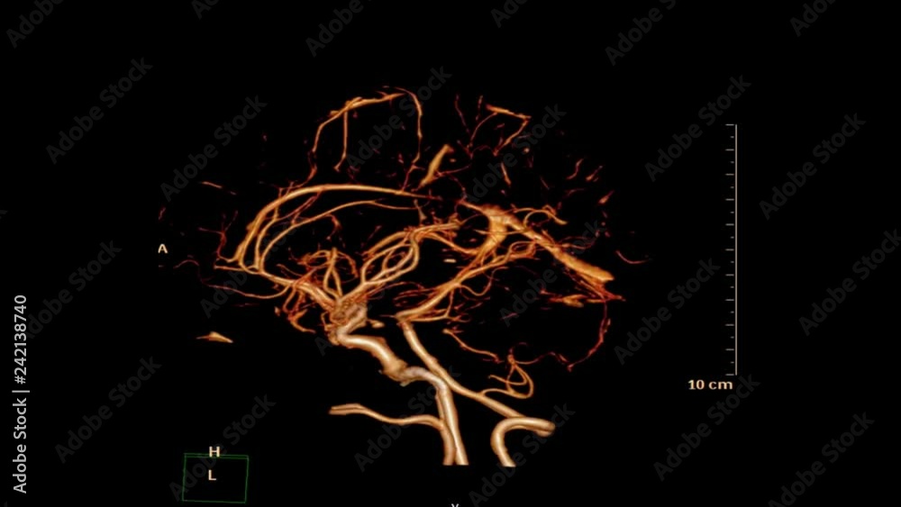 CT angiography of the brain or cta brain, 3D Rendering image rotating ...