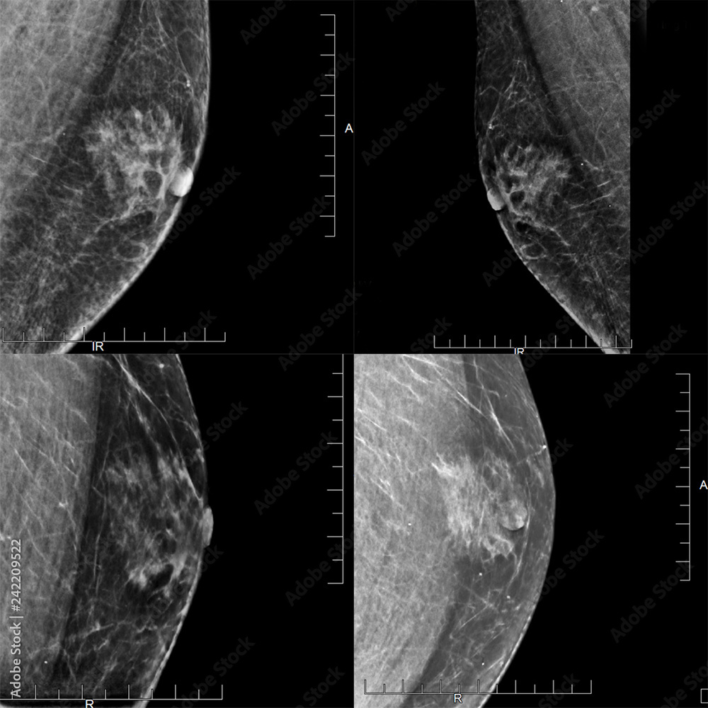A Series of Four Mammogram images Showing a Male Patient's Gynecomastia ...