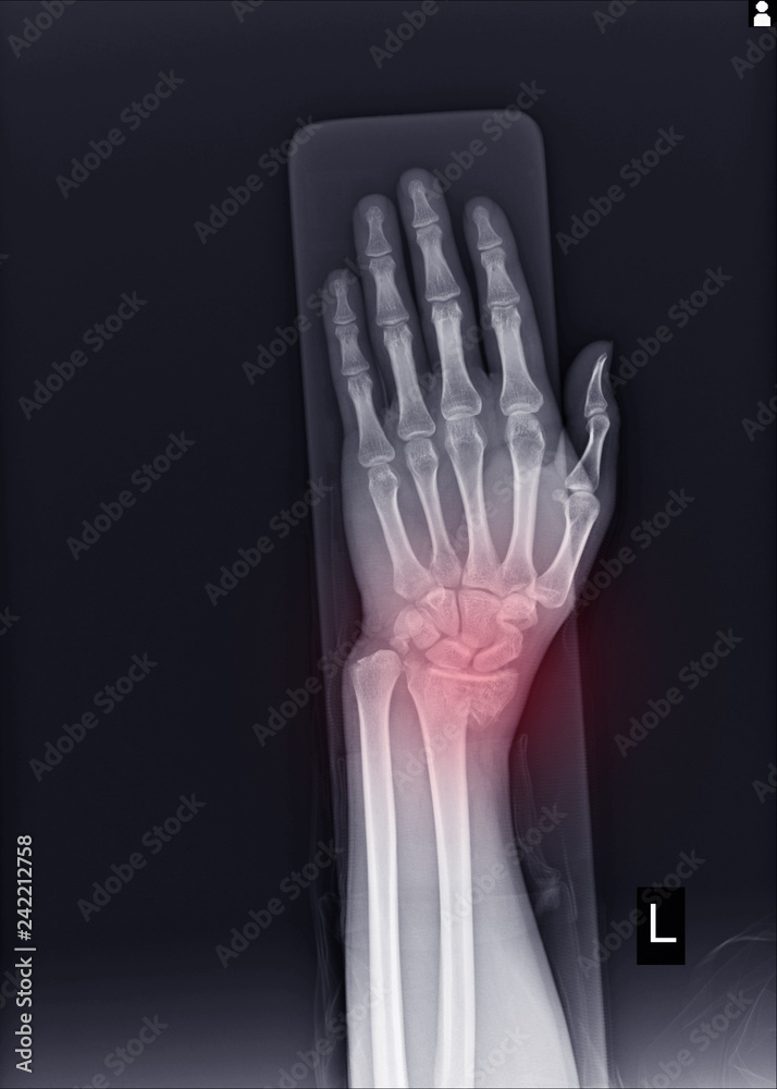X-ray Left wrist joint Fracture with displacement distal end left ...