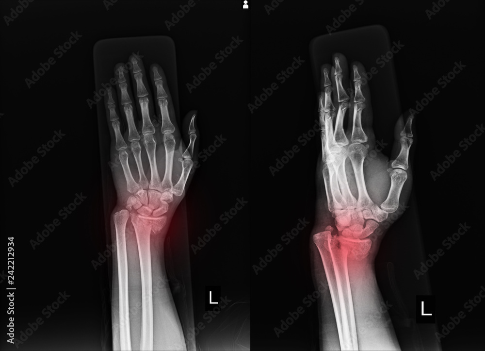 X-ray Left wrist joint Fracture with displacement distal end left ...