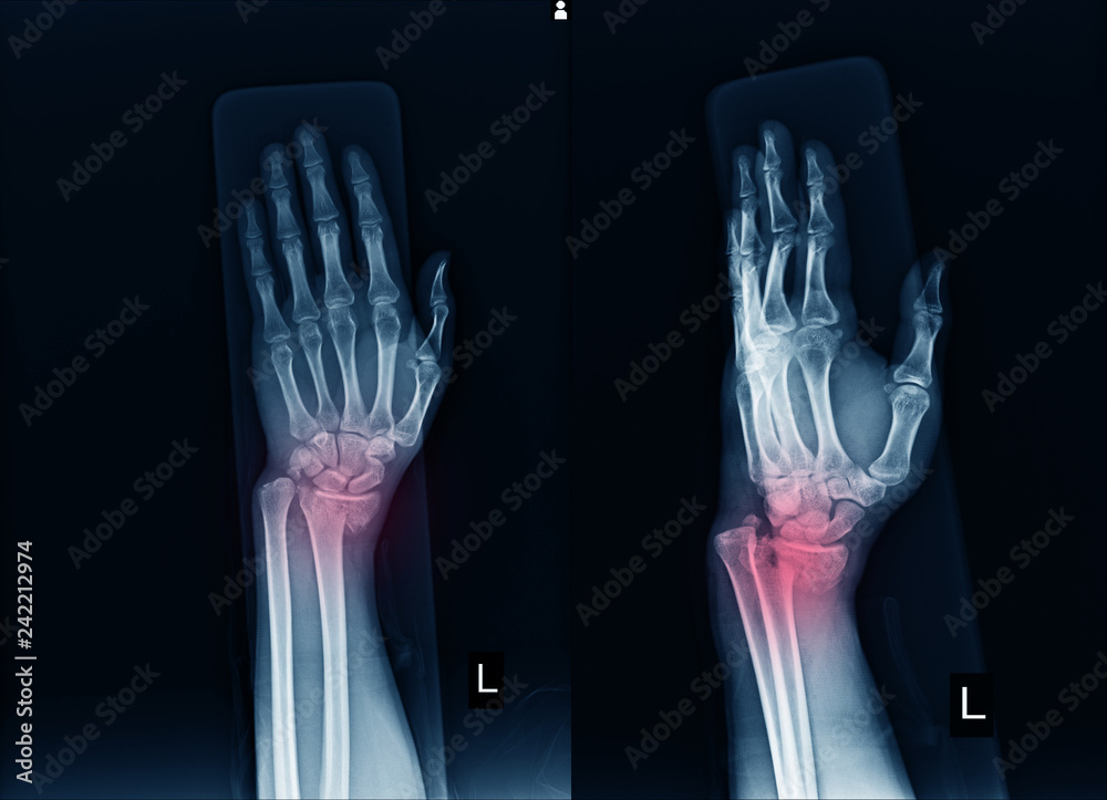 X-ray Left wrist joint Fracture with displacement distal end left ...