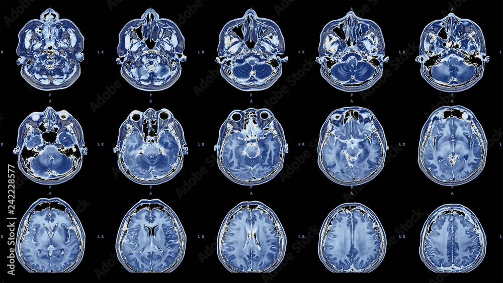 magnetic resonance image (MRI) of the brain Stock Photo | Adobe Stock