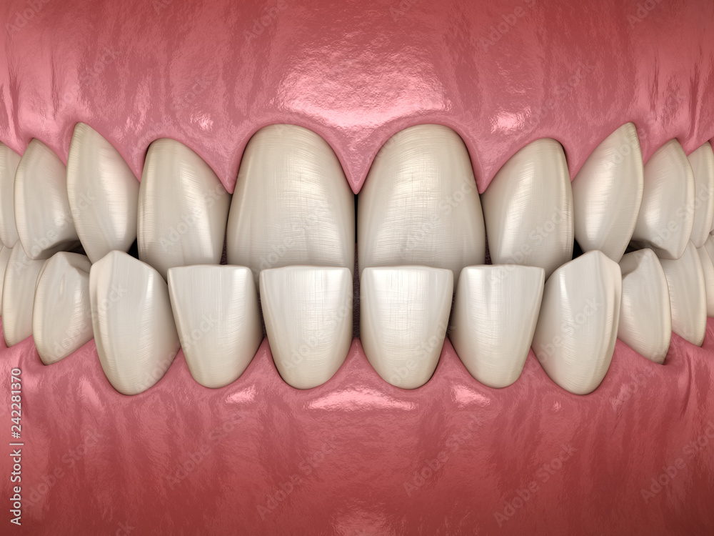Underbite dental occlusion ( Malocclusion of teeth ). Medically ...