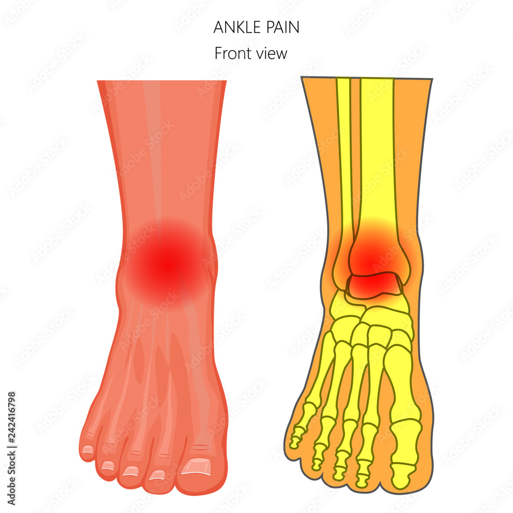 Vector illustration of unhealthy human foot with ankle joint pain or ...