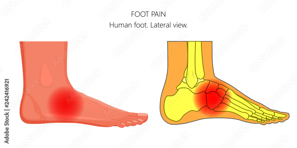 Vector illustration of unhealthy human foot with midfoot pain or injury ...
