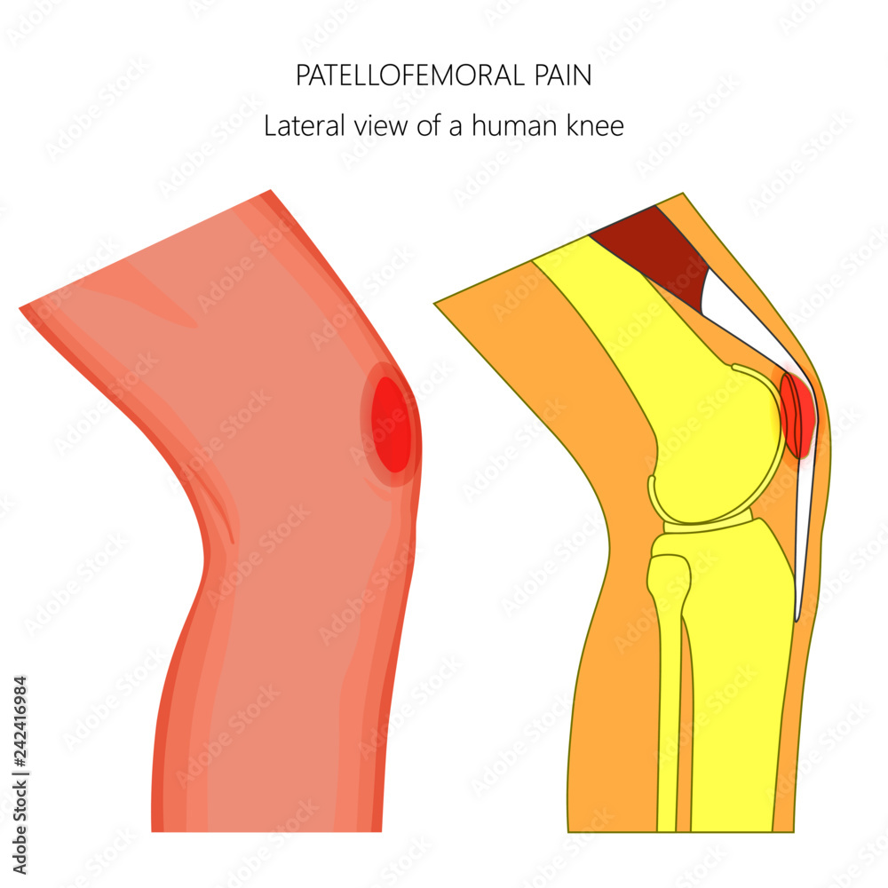 Vector illustration of unhealthy human knee joint with patellofemoral ...