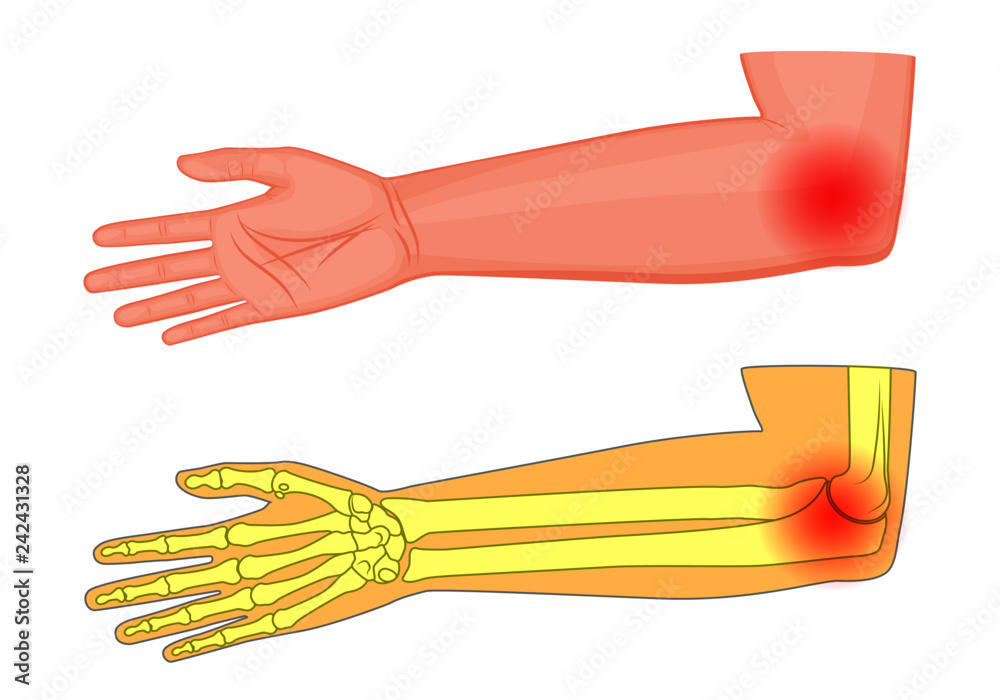 Vector illustration of a human elbow joint with a pain or injury ...