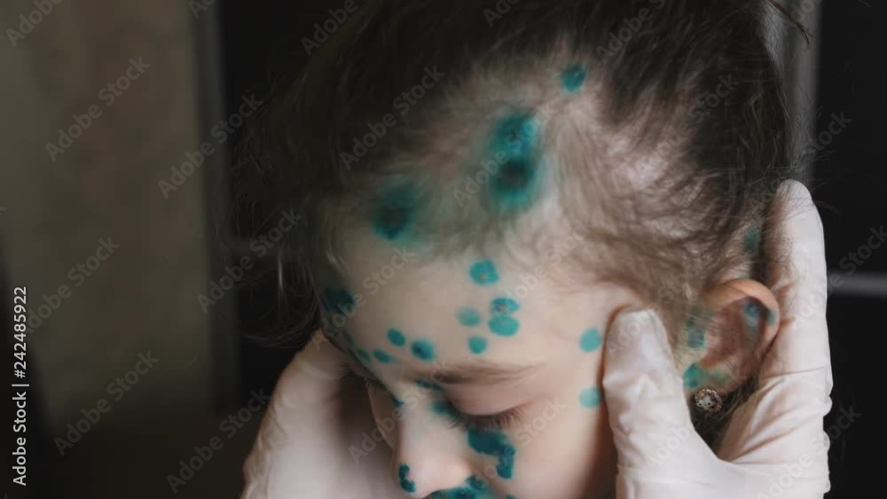 Close-up of a woman inspects the face of the little girl covered with ...