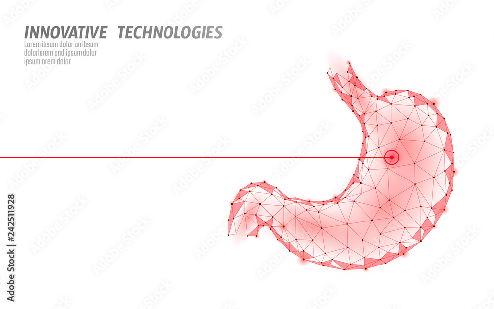 Human stomach laser surgery operation low poly. Medicine disease drug ...