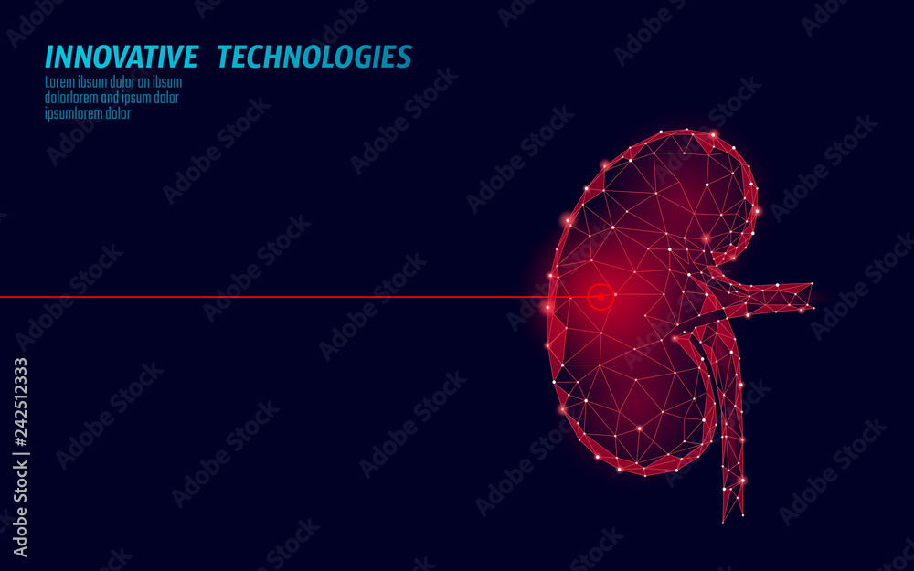 Poster Human kidneys laser surgery operation low poly – Wall Art ...