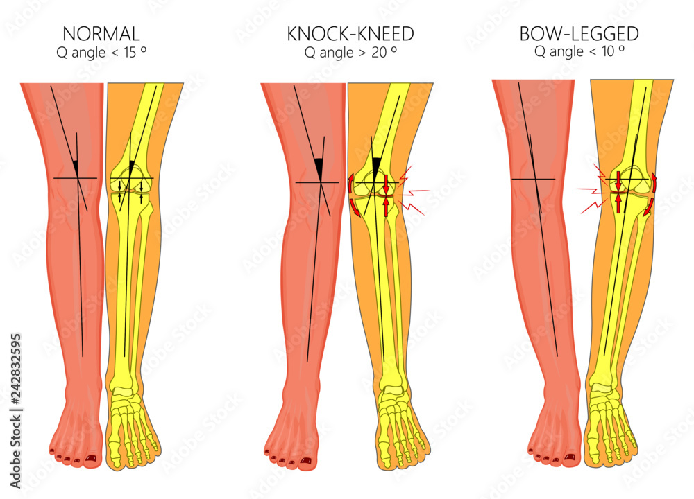 Stockvector Vector illustration diagram. Shapes of human legs. Normal ...