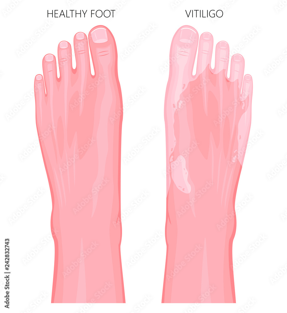 Vector illustration of a healthy foot and a foot with vitiligo, loss of ...