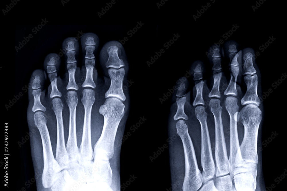 Gouty arthritis . film x-ray of left toe front and oblique view. Stock ...