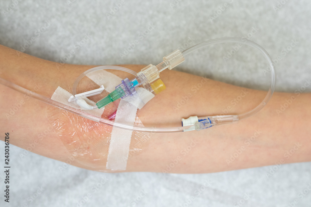 Young adult female arm with intravenous injection at the emergency room ...