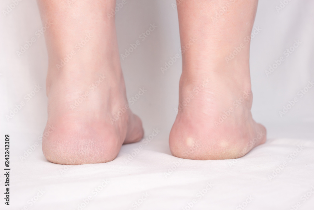 Female feet with spots on a white background with heel spur disease ...